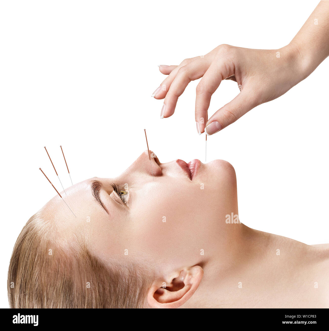 Woman undergoing acupuncture treatment. Isolated on white Stock Photo ...