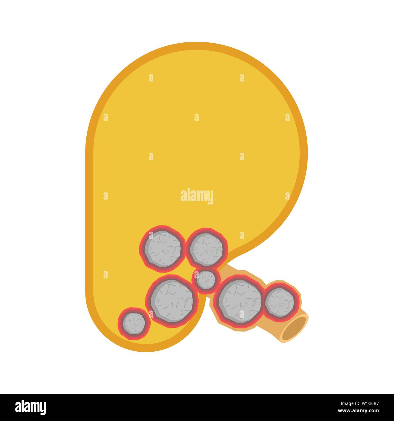 Stones in kidneys. Nephrolithiasis kidney stones disease. Medical ...