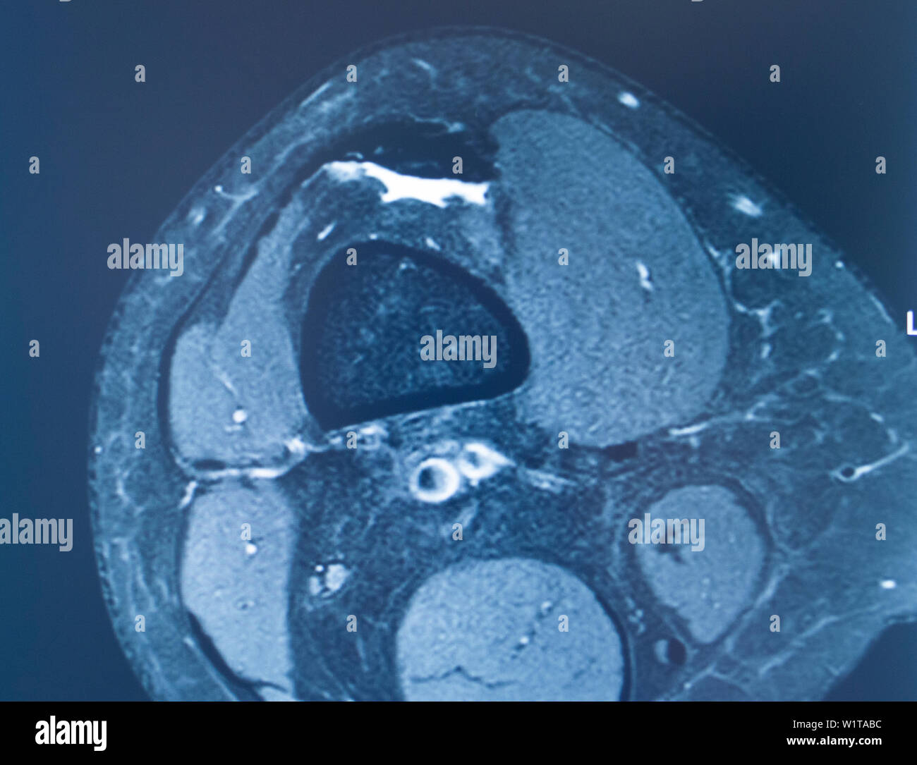 Knee sports injury mri mcl grade 2 tear magnetic resonance imaging ...
