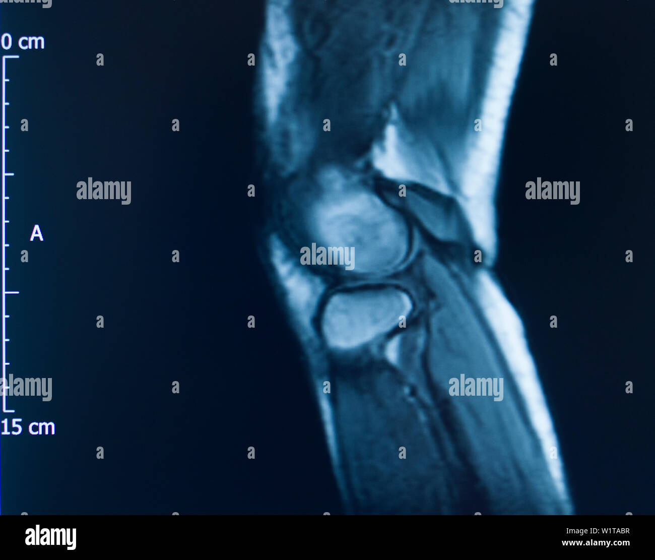 Knee sports injury mri mcl grade 2 tear magnetic resonance imaging ...