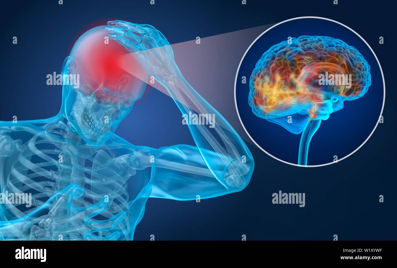 Head pain Attack, man suffering from brain pain. 3D illustration Stock ...