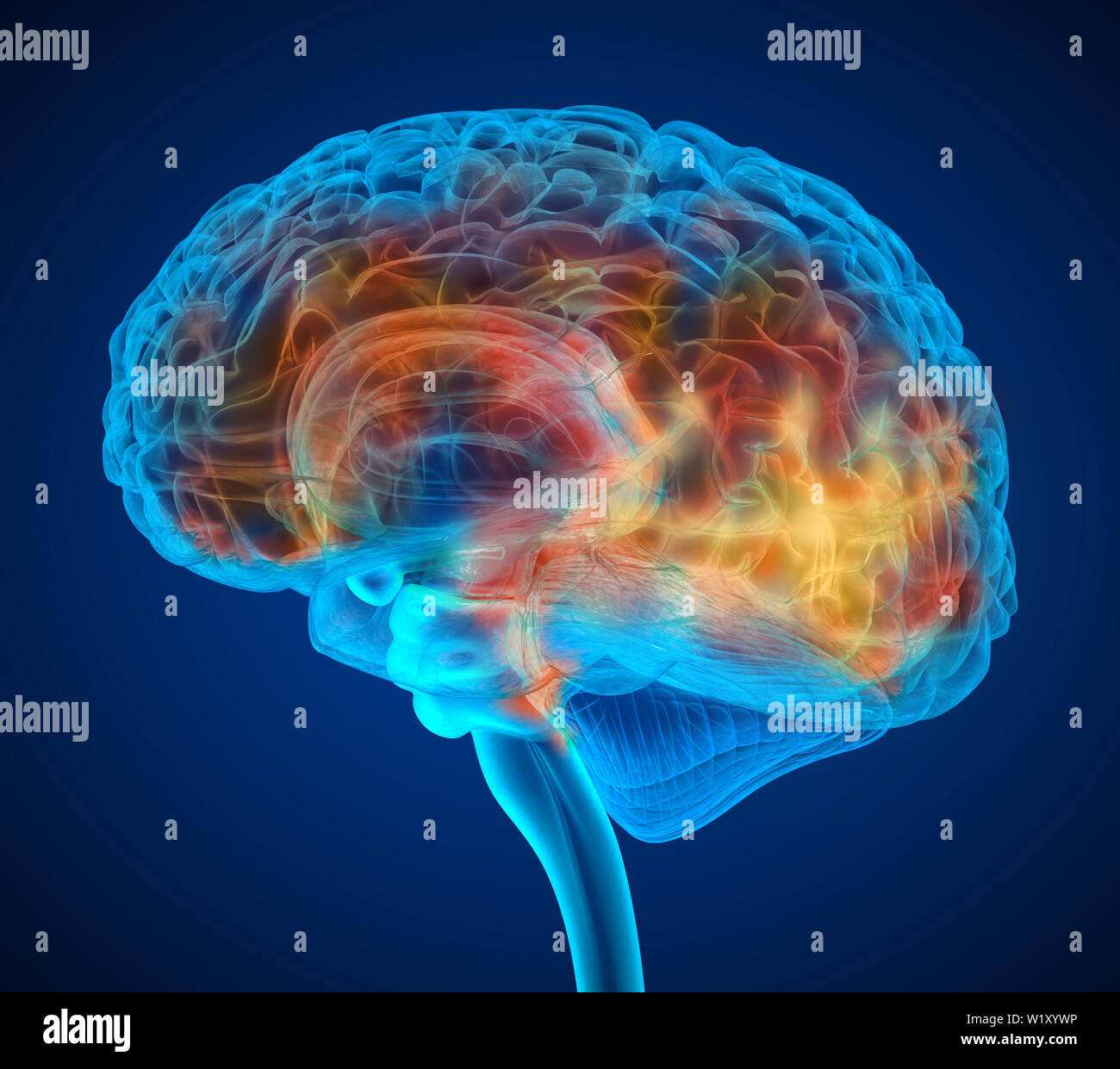 Human brain tumor X-ray scan , Medically accurate 3D illustration Stock ...