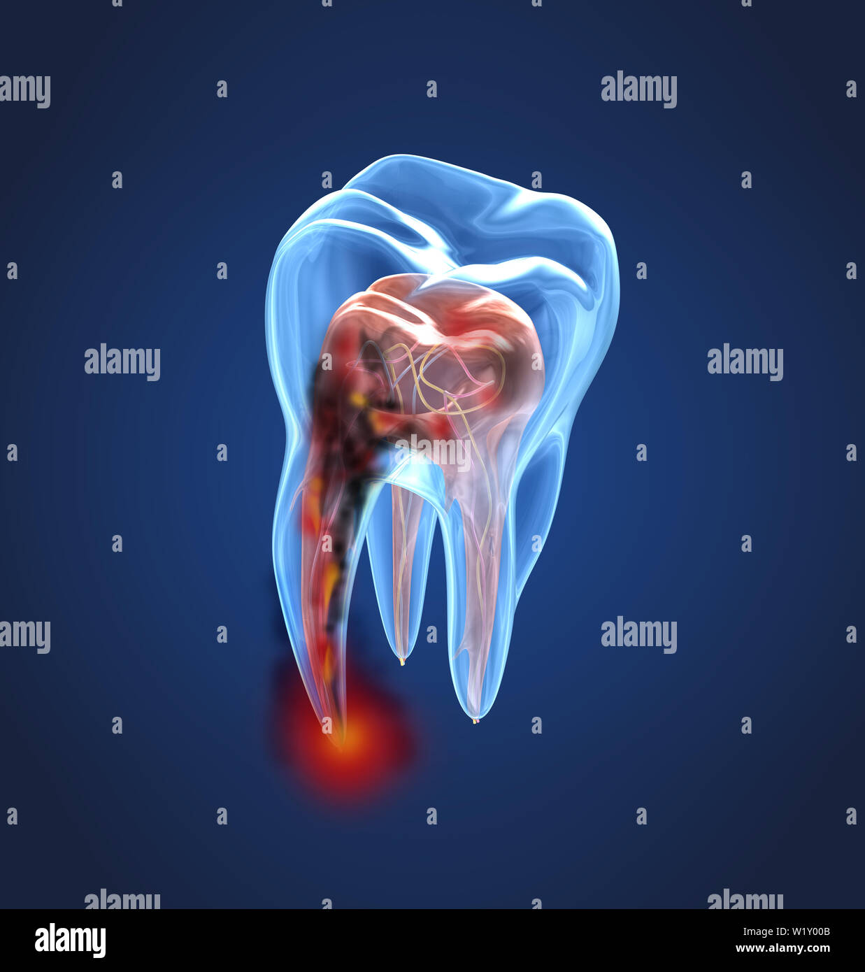 Teeth xray hi-res stock photography and images - Alamy