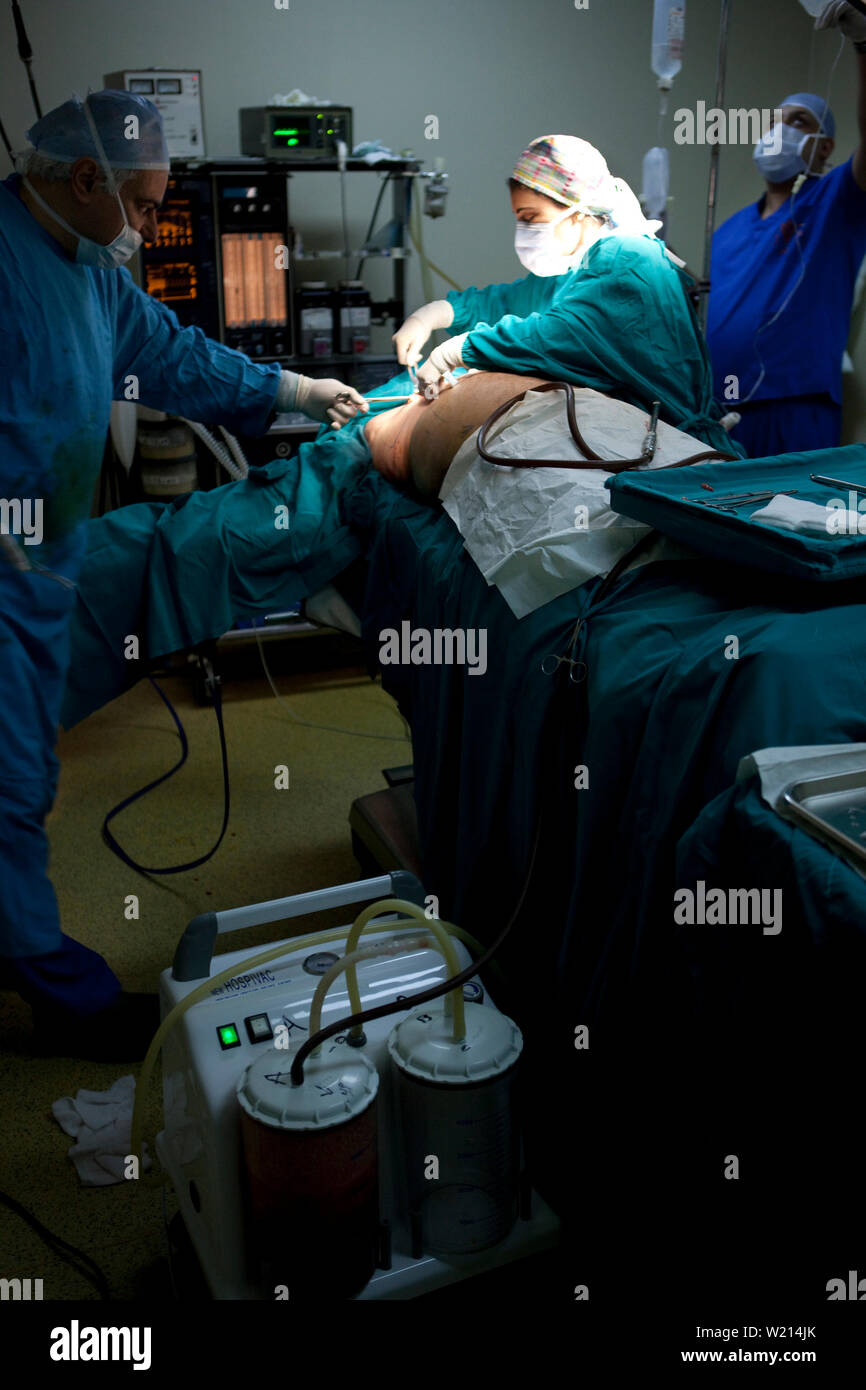 Fat reduction procedure hi-res stock photography and images - Alamy