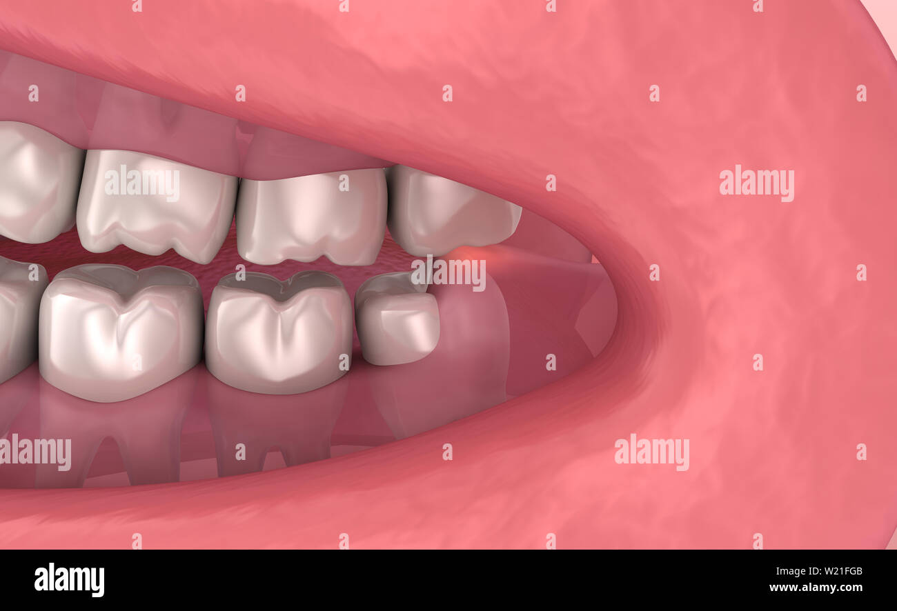 Wisdom tooth problem. Medically accurate tooth 3D animation Stock Photo ...