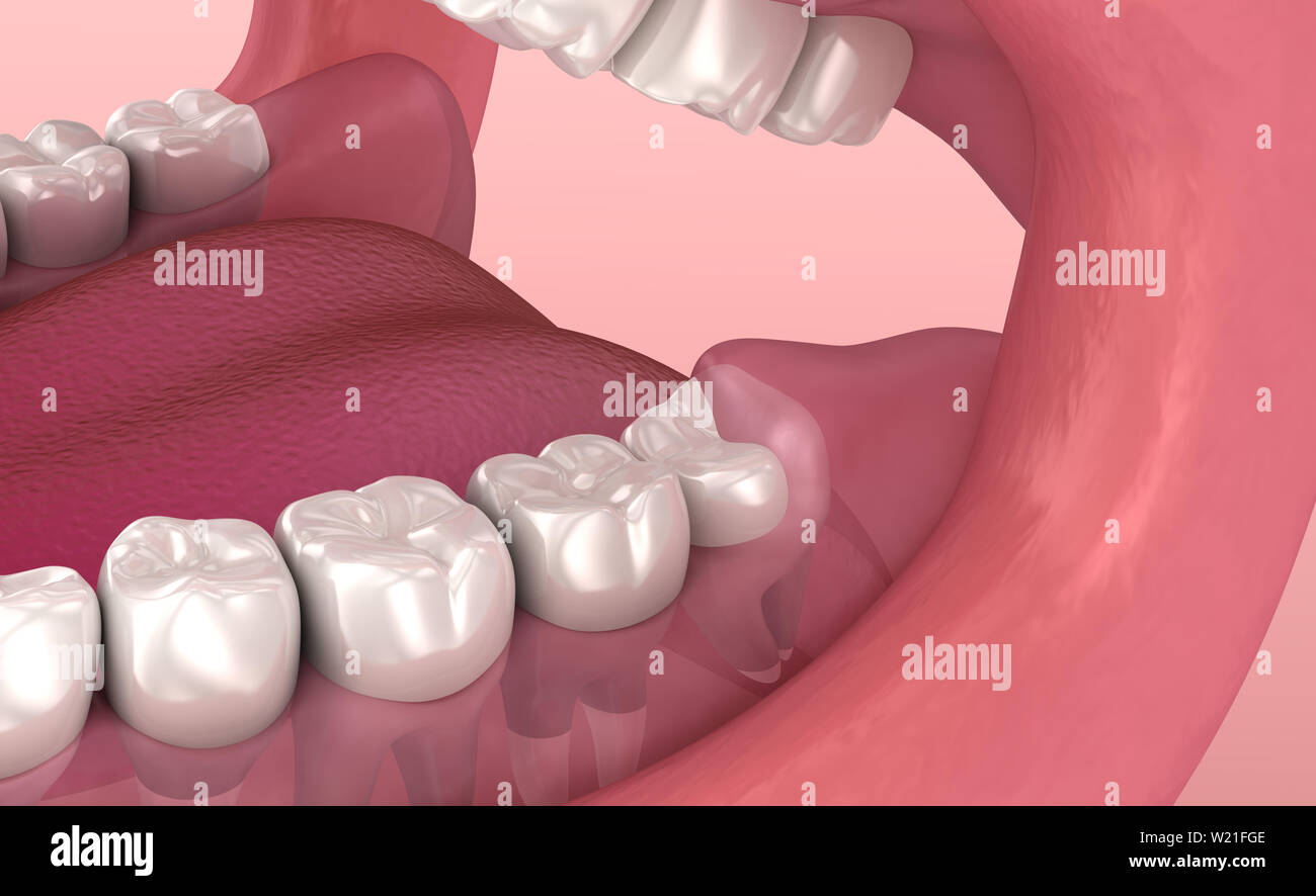 Wisdom tooth problem. Medically accurate tooth 3D animation Stock Photo ...