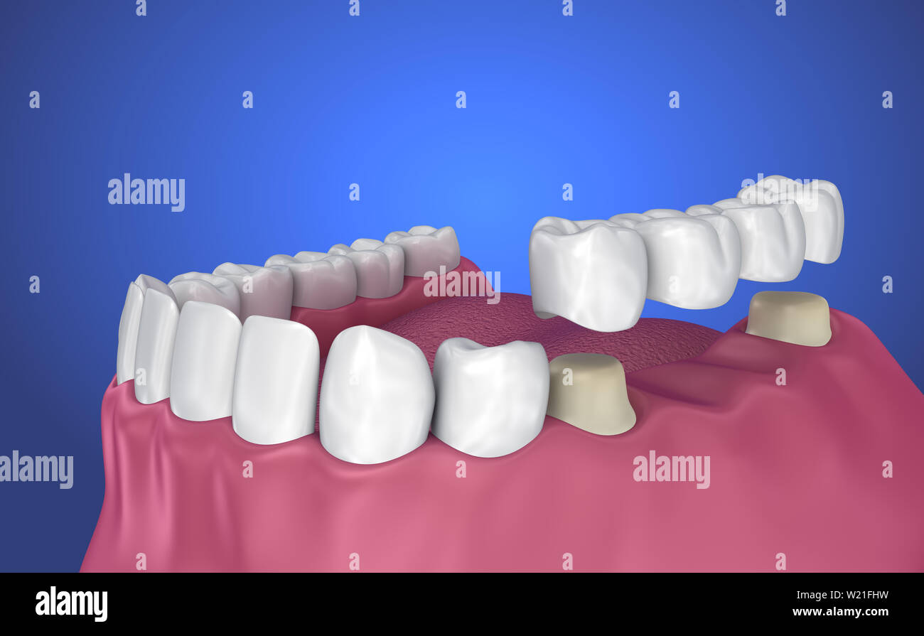 Tooth supported fixed bridge, implant and crown. Medically accurate 3D ...