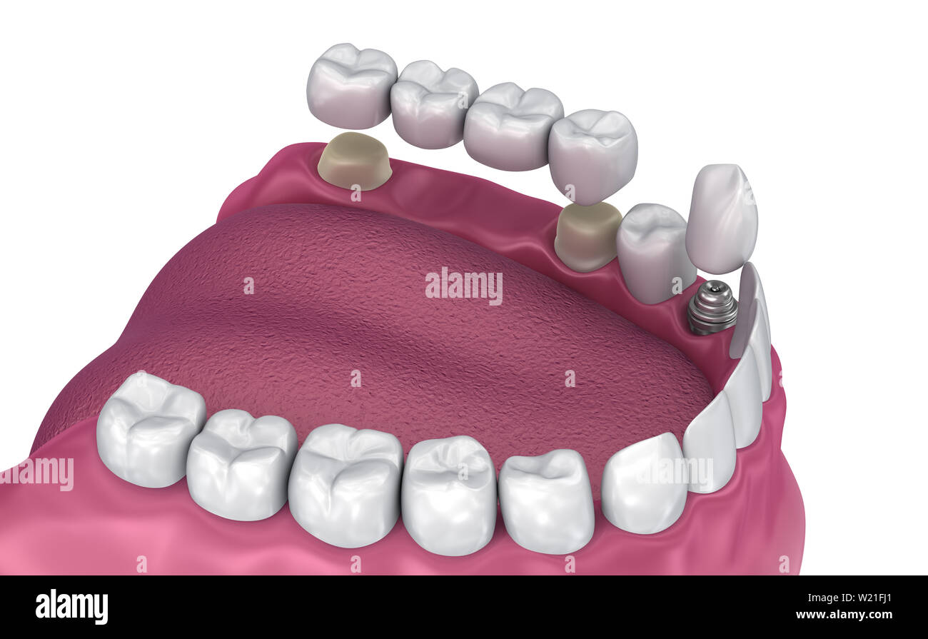 Tooth supported fixed bridge, implant and crown. Medically accurate 3D ...
