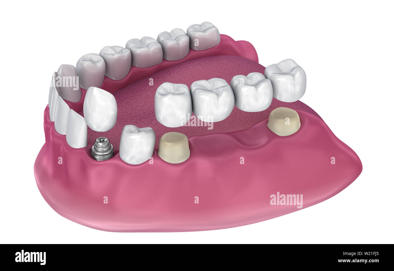 Tooth supported fixed bridge, implant and crown. Medically accurate 3D ...