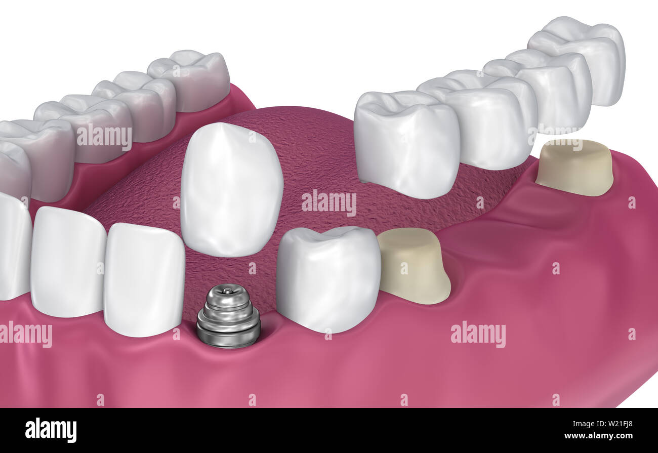 Tooth supported fixed bridge, implant and crown. Medically accurate 3D ...
