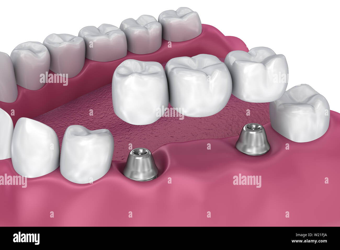 implant supported fixed bridge. Medically accurate 3D illustration ...