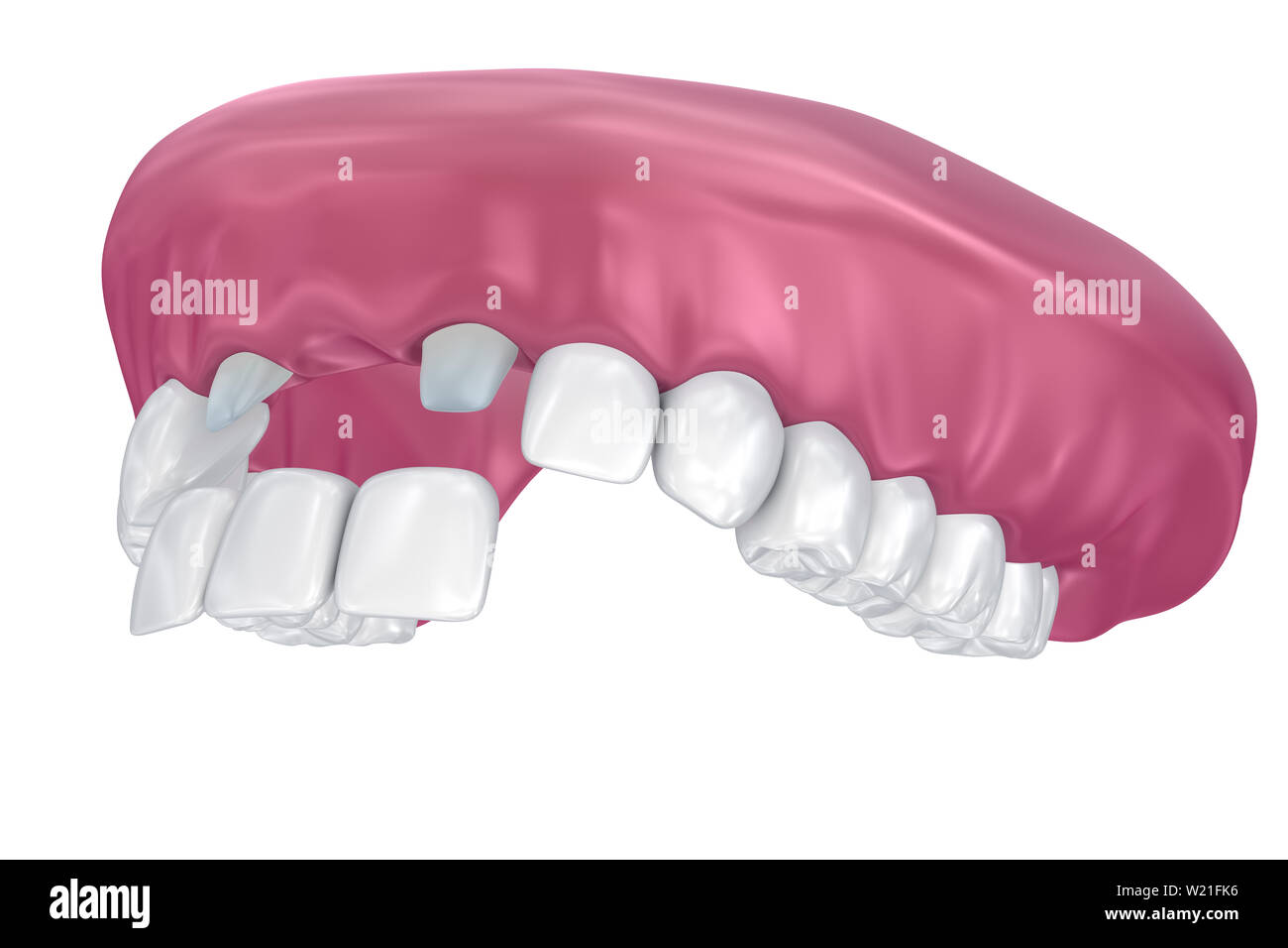 Tooth supported fixed bridge. Medically accurate 3D illustration Stock ...