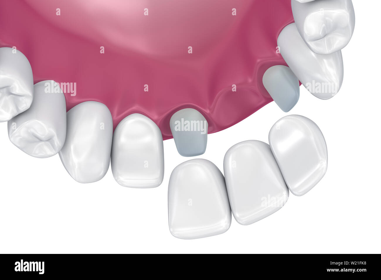 Tooth supported fixed bridge. Medically accurate 3D illustration Stock ...