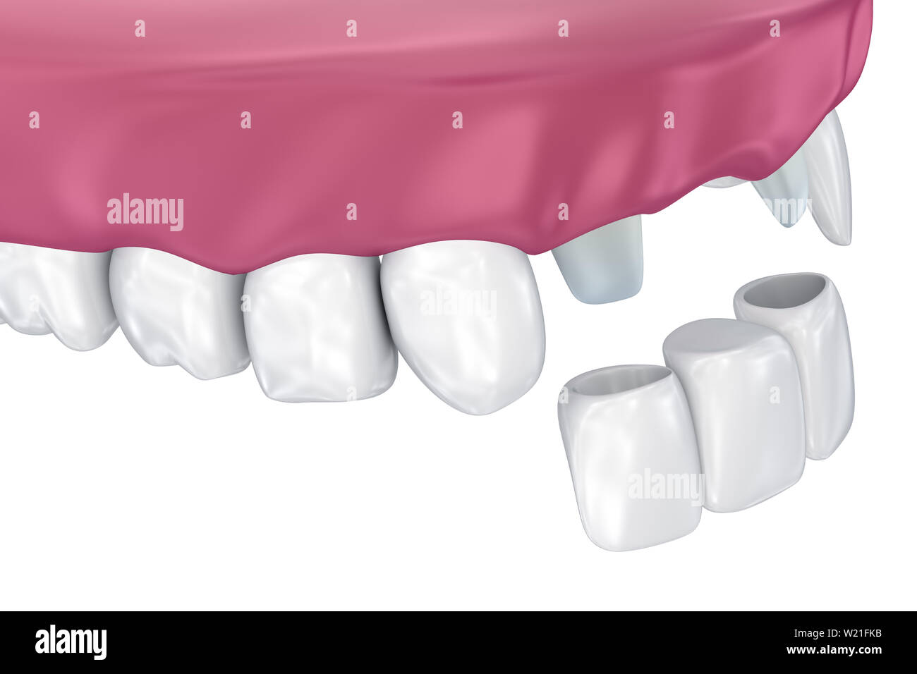 Tooth supported fixed bridge. Medically accurate 3D illustration Stock ...