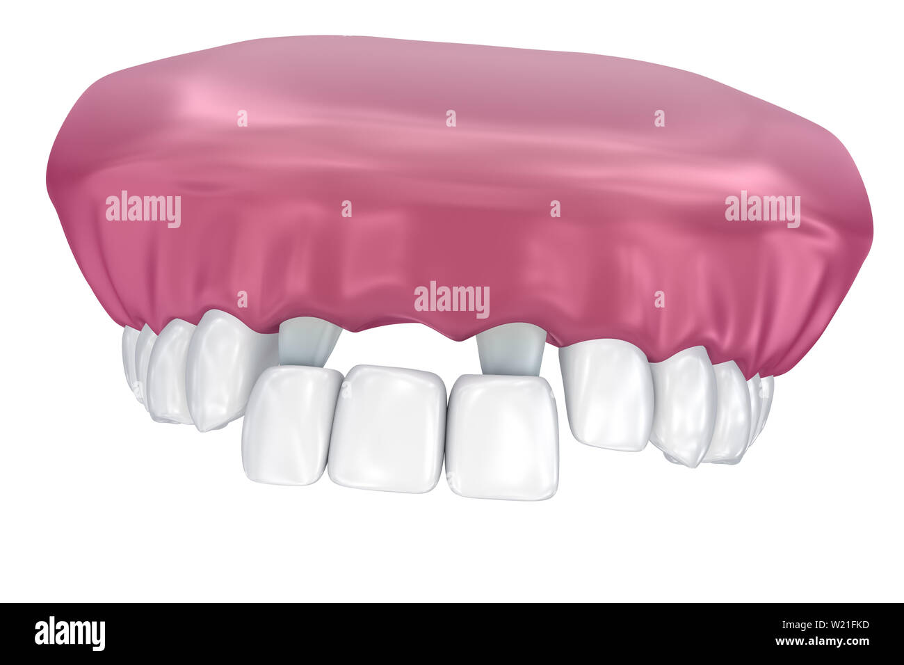 Tooth supported fixed bridge. Medically accurate 3D illustration Stock ...