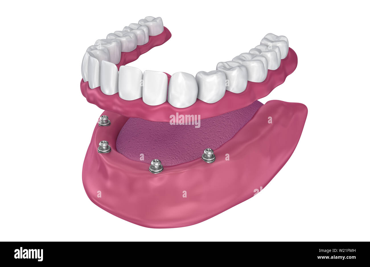 Overdenture to be seated on implants - ball attachments. 3D ...