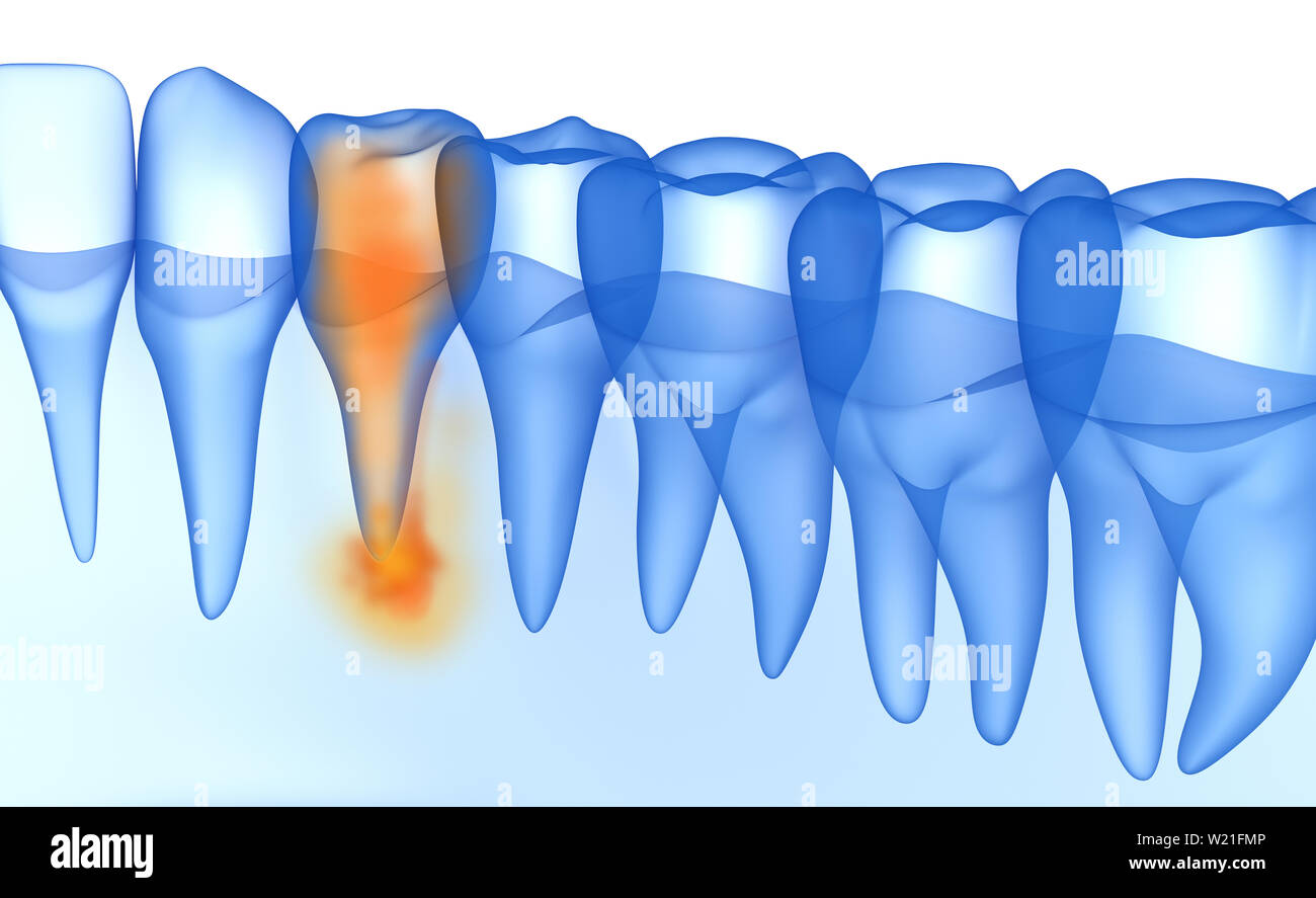 Mouth gum and teeth xray view. Teeth problem. Medically accurate tooth ...