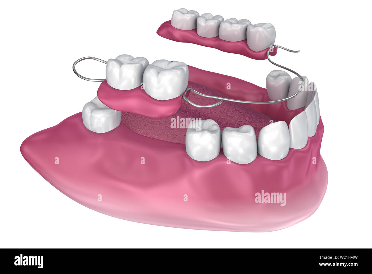 Removable partial denture. Medically accurate 3D illustration Stock ...