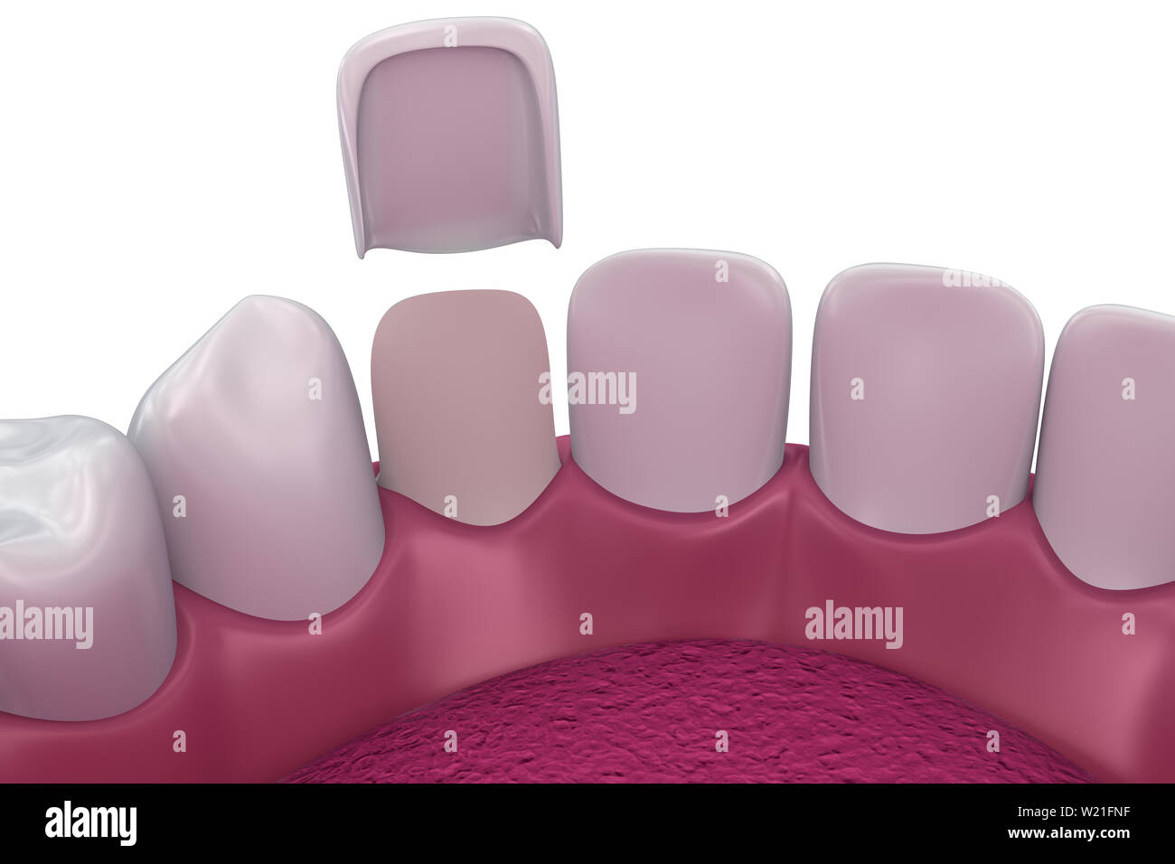 Dental Veneers: Porcelain Veneer installation Procedure. 3D ...