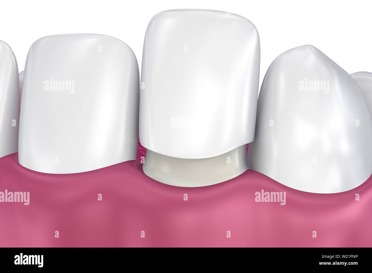 Dental Veneers: Porcelain Veneer installation Procedure. 3D ...