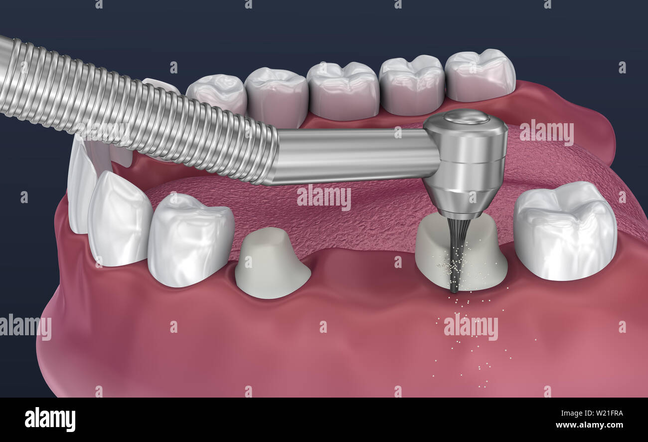 Tooth supported fixed bridge of 3 teeth. Medically accurate 3D ...