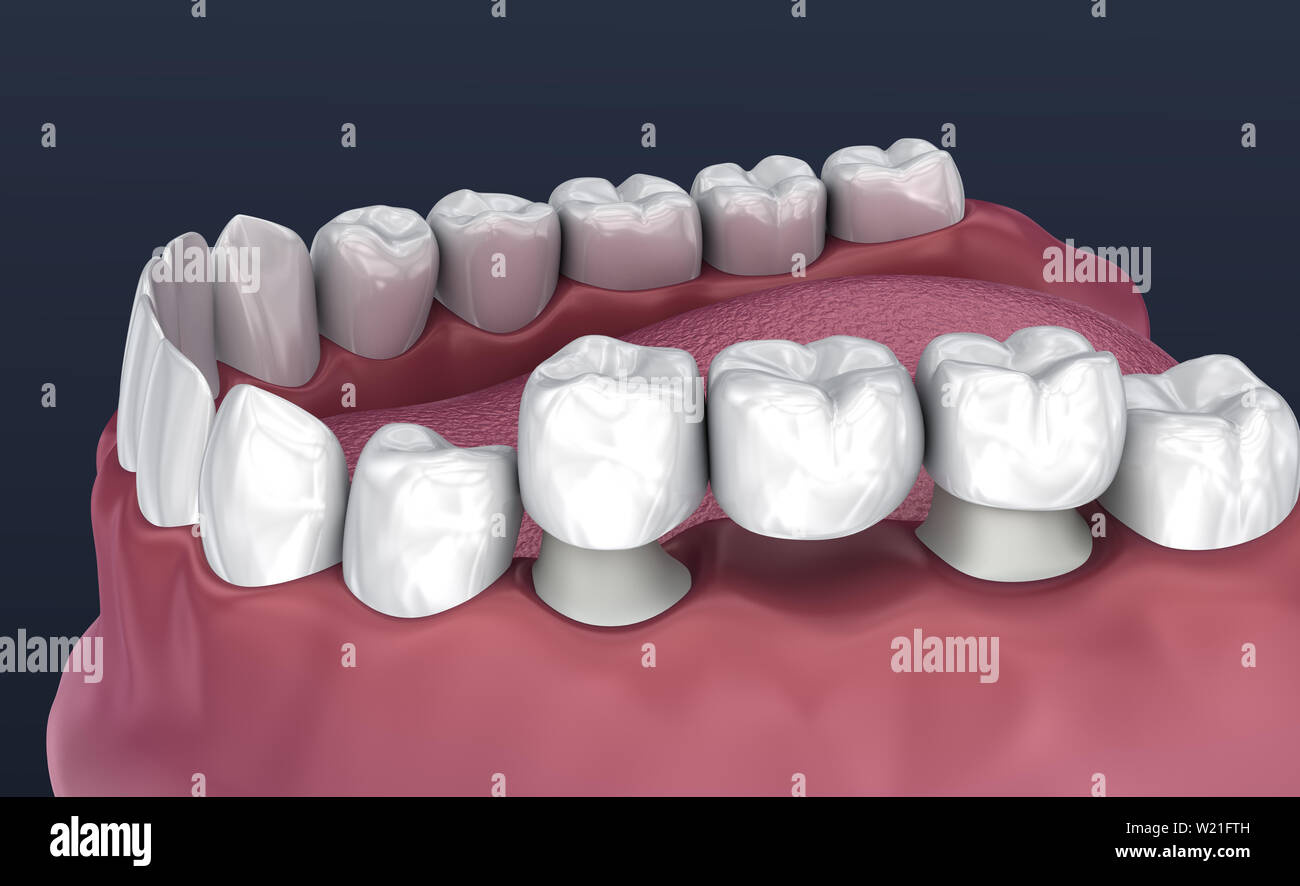 Tooth supported fixed bridge of 3 teeth. Medically accurate 3D ...