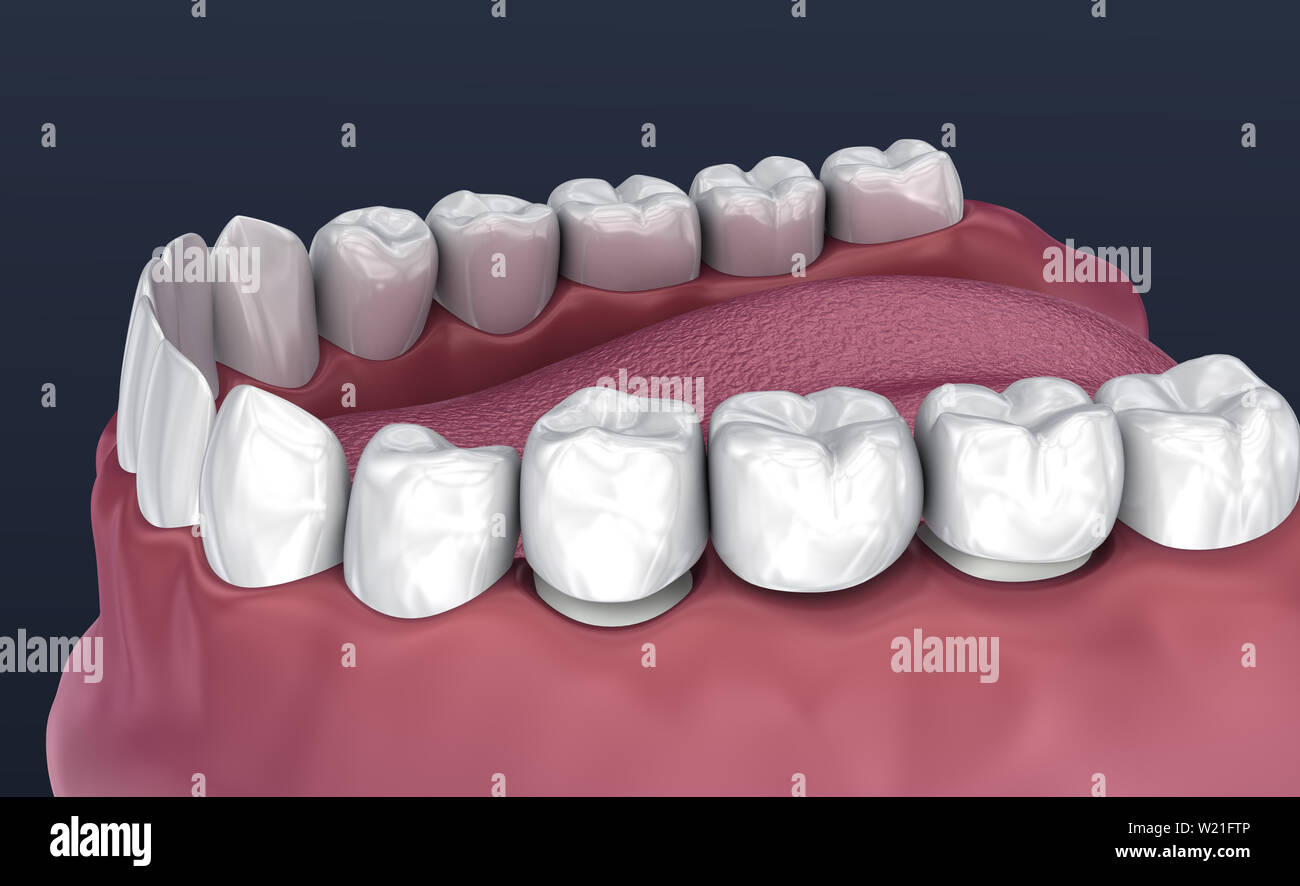 Tooth supported fixed bridge of 3 teeth. Medically accurate 3D ...