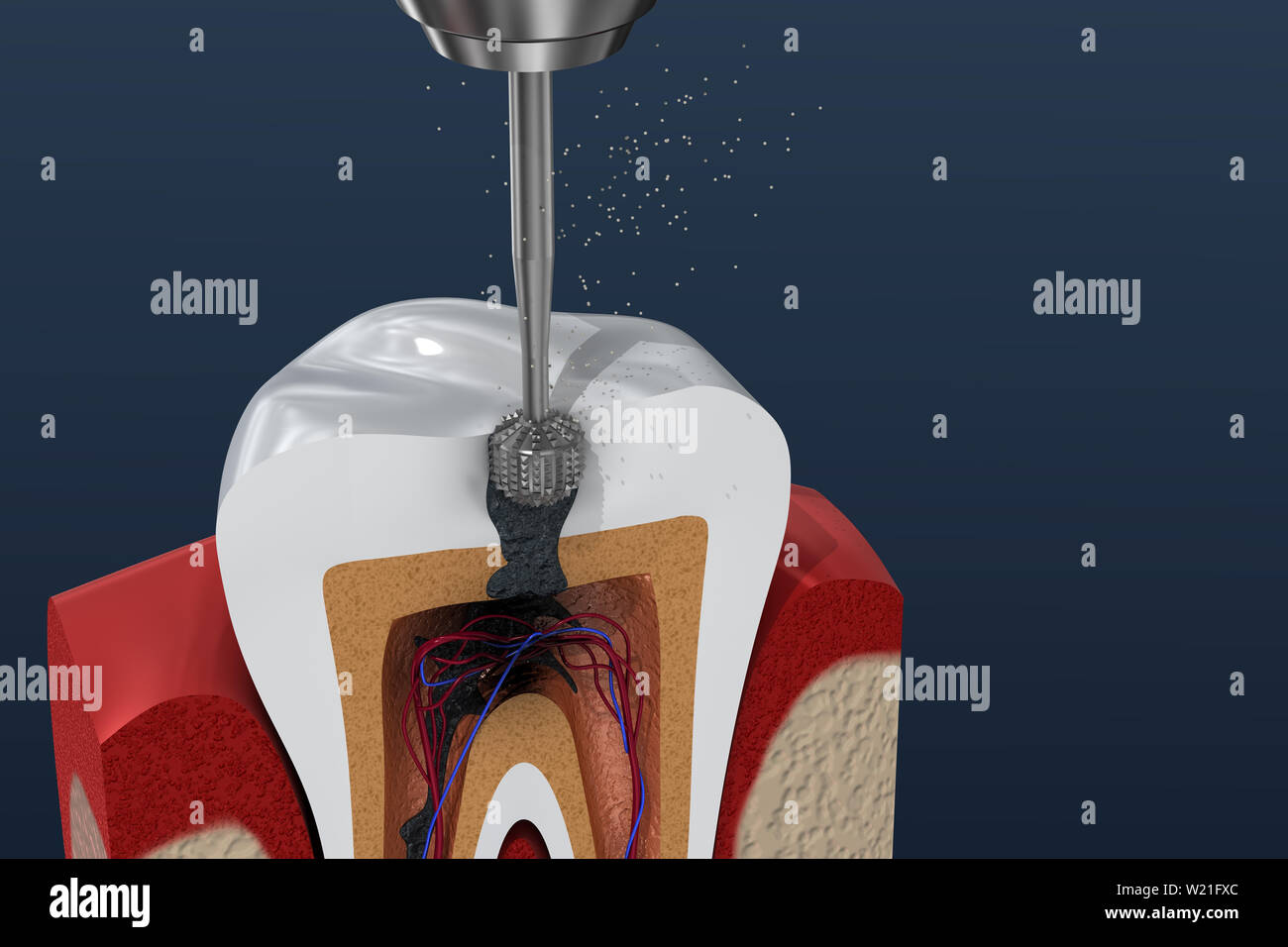 Root canal treatment process. 3D illustration Stock Photo - Alamy