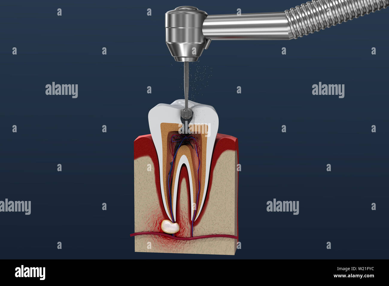 Root canal treatment process. 3D illustration Stock Photo - Alamy