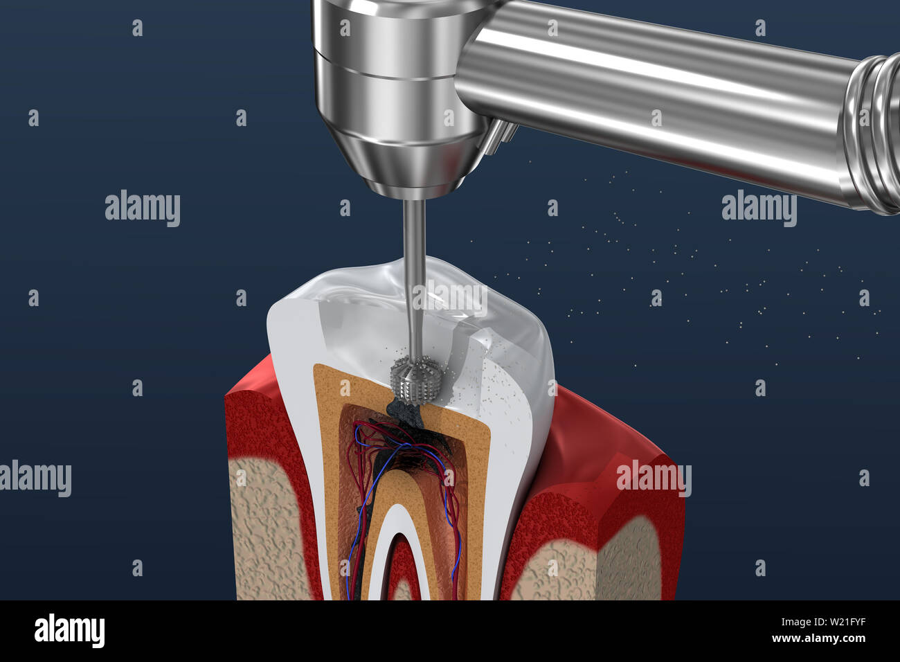 Root canal treatment process. 3D illustration Stock Photo - Alamy