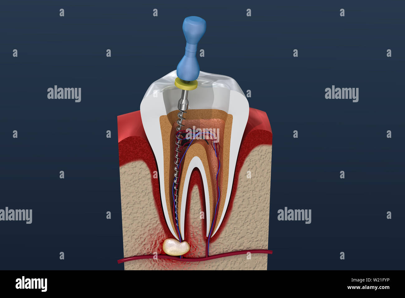 Root canal treatment process. 3D illustration Stock Photo - Alamy
