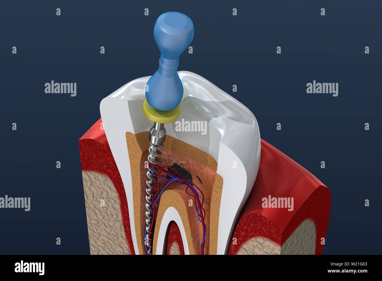 Root canal treatment process. 3D illustration Stock Photo - Alamy