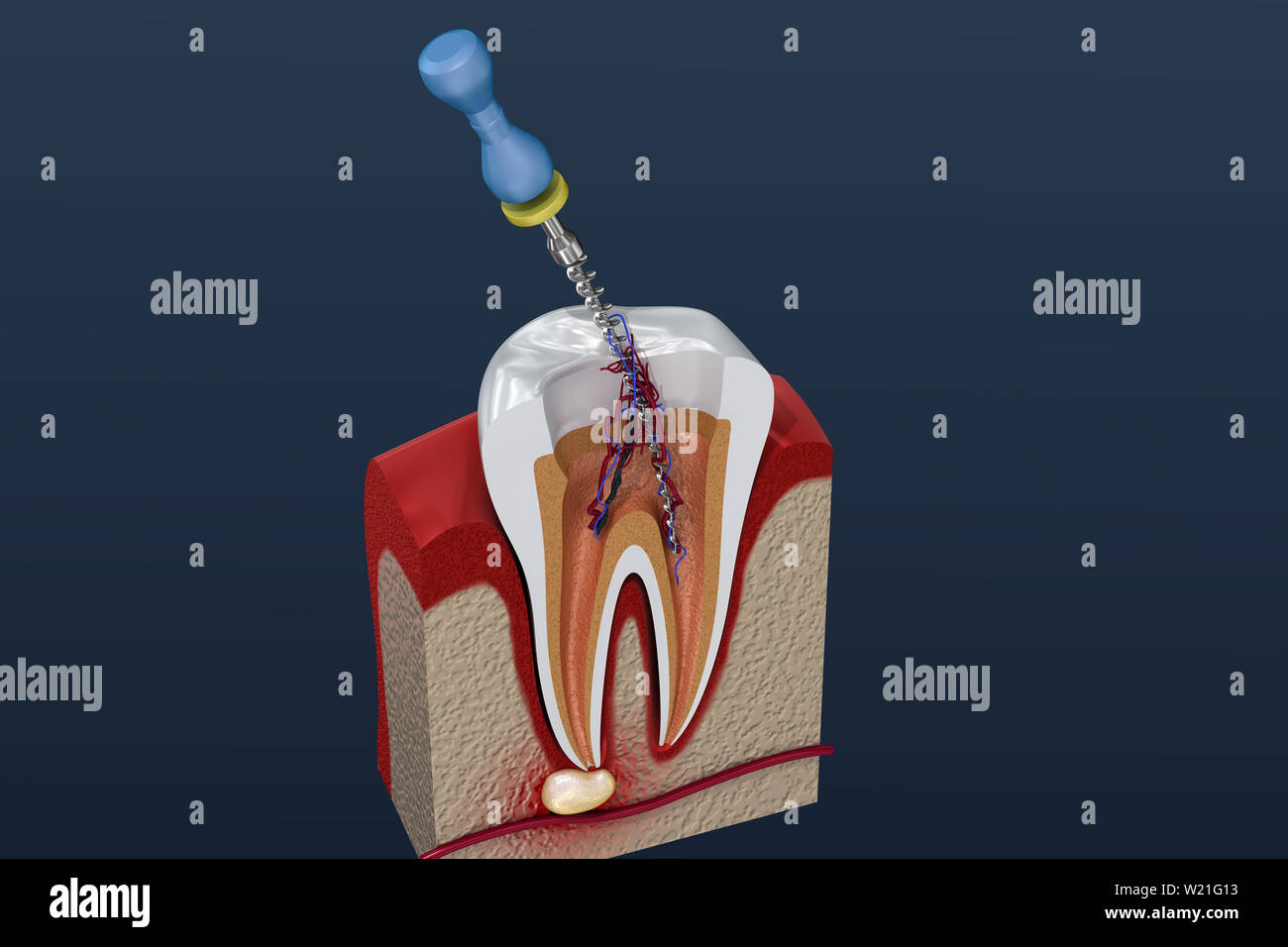 Root canal treatment process. 3D illustration Stock Photo - Alamy