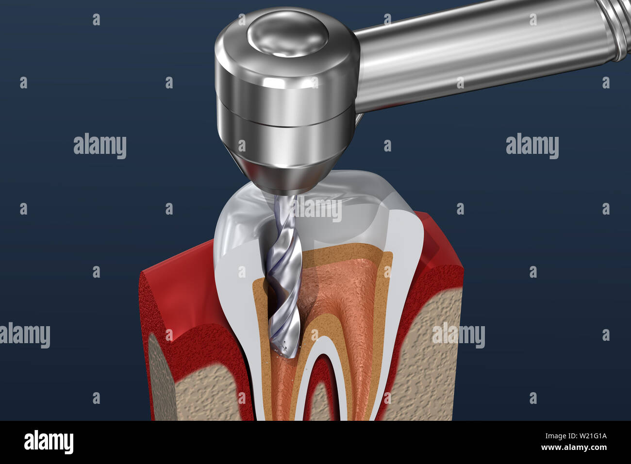 Root canal treatment process. 3D illustration Stock Photo - Alamy