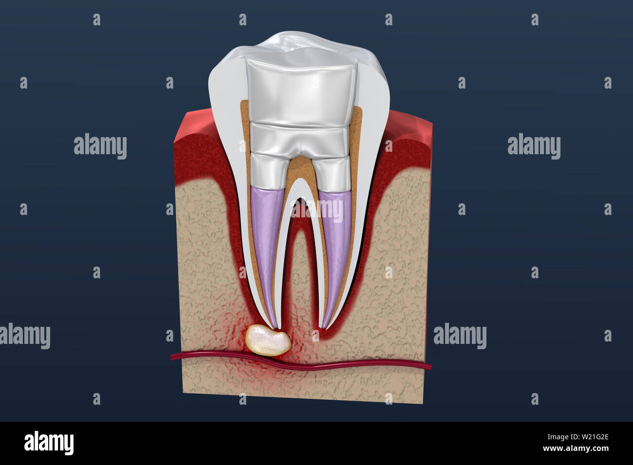 Dental fillings procedure diagramm . 3D illustration Stock Photo - Alamy