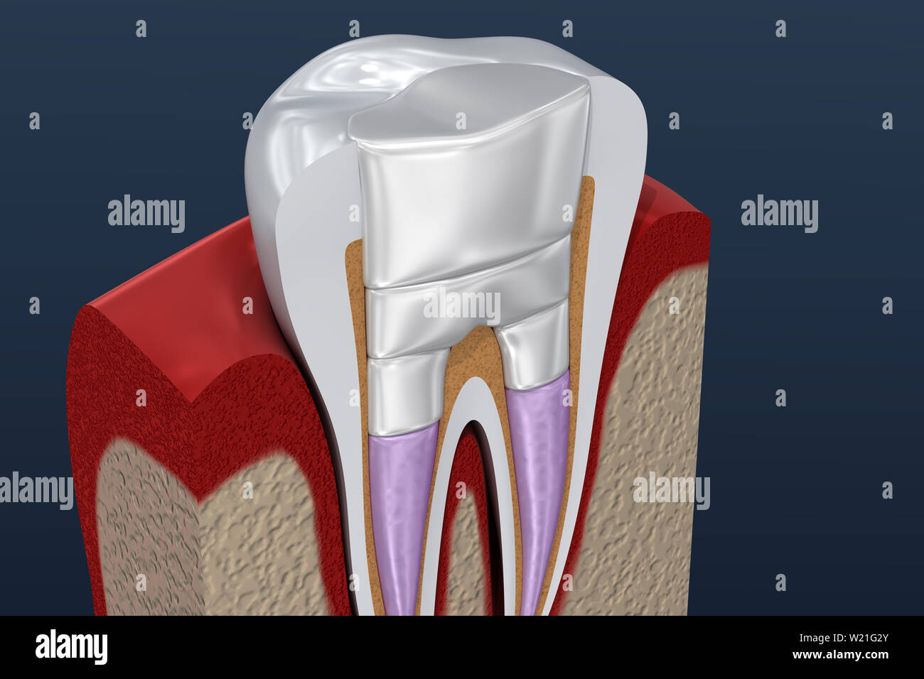 Dental fillings procedure diagramm . 3D illustration Stock Photo - Alamy