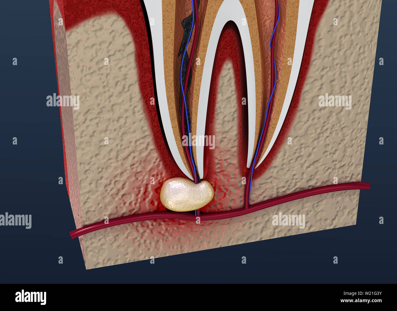 Tooth decay. 3D illustration Stock Photo - Alamy