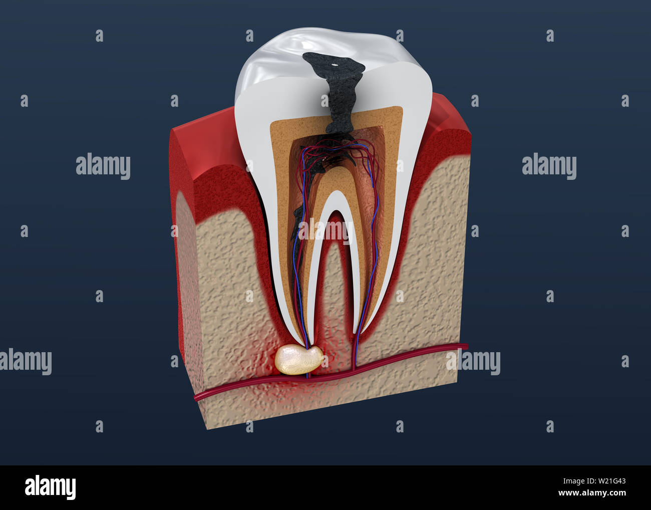 Tooth decay. 3D illustration Stock Photo - Alamy