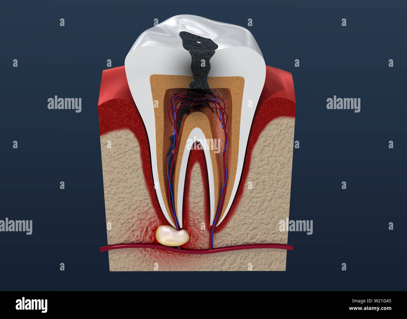 Tooth decay. 3D illustration Stock Photo - Alamy