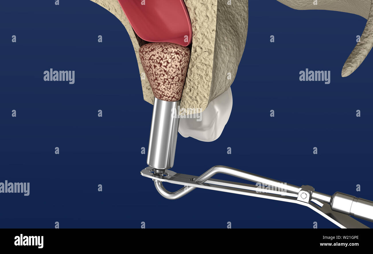 Sinus Lift Surgery - Sinus Augmentation. 3D illustration Stock Photo ...