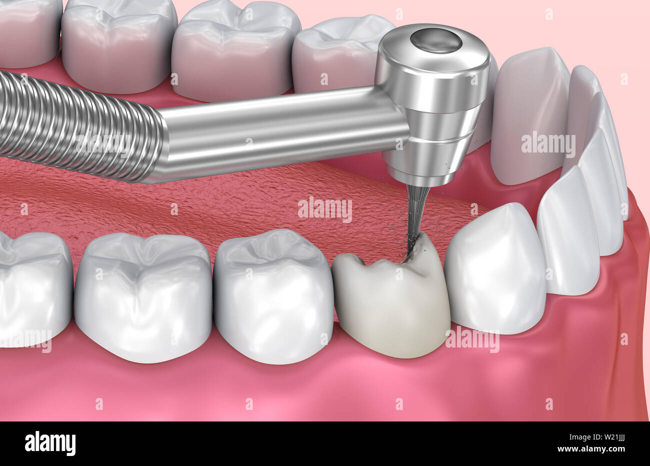 Removing the caries . Medically accurate tooth 3D illustration Stock ...