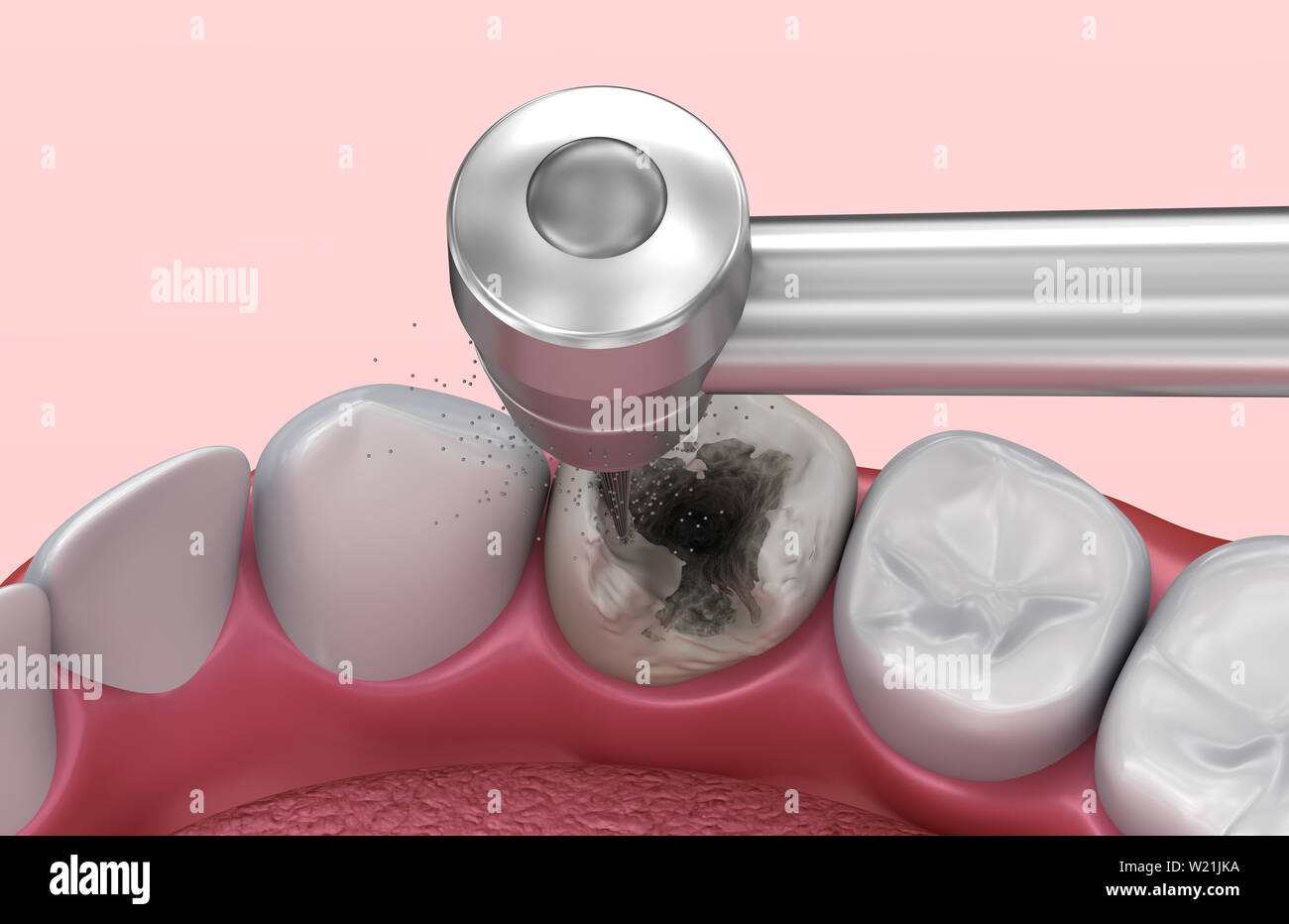 Removing the caries . Medically accurate tooth 3D illustration Stock ...