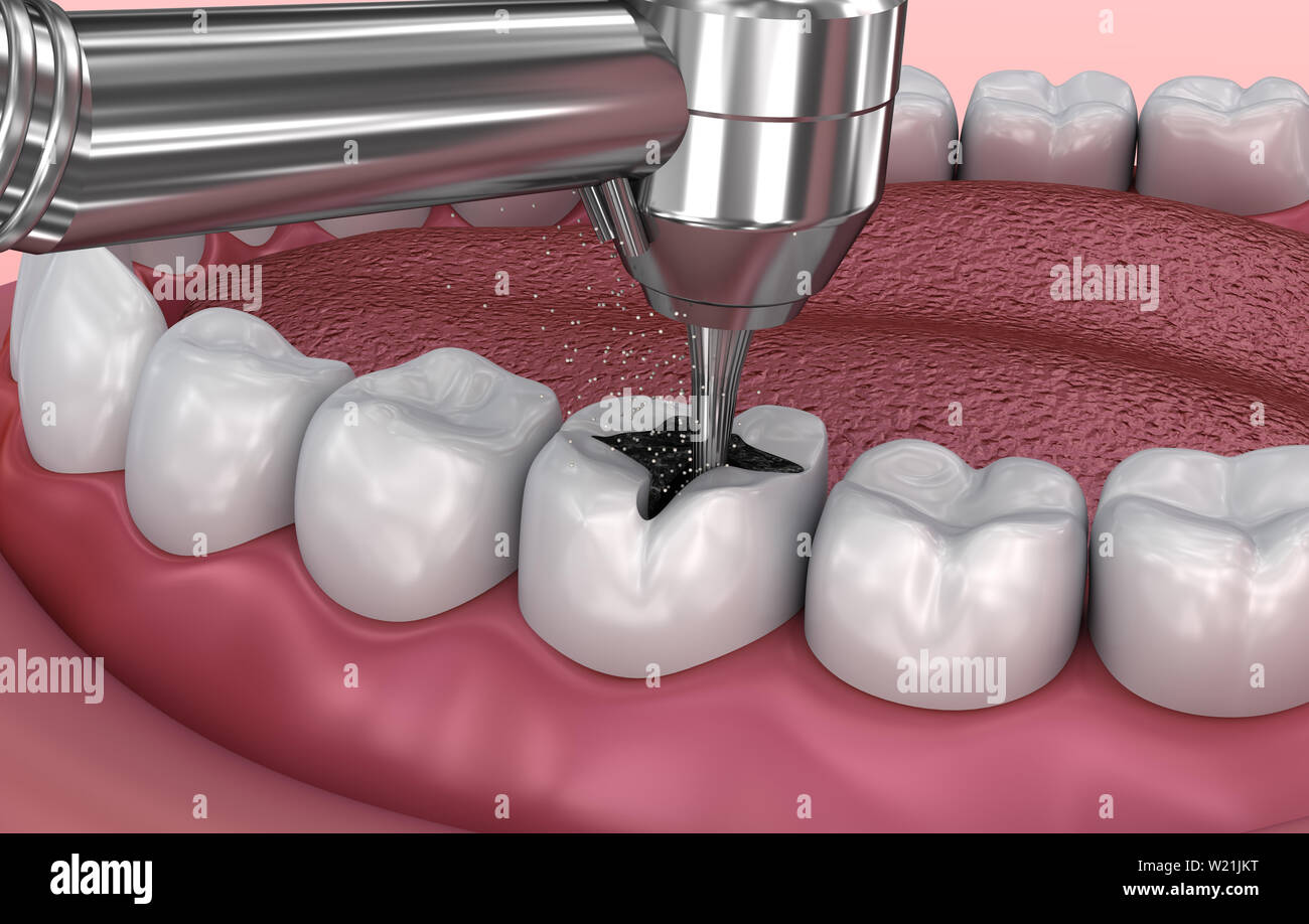 Dental fissure fillings, Medically accurate 3D illustration Stock Photo ...