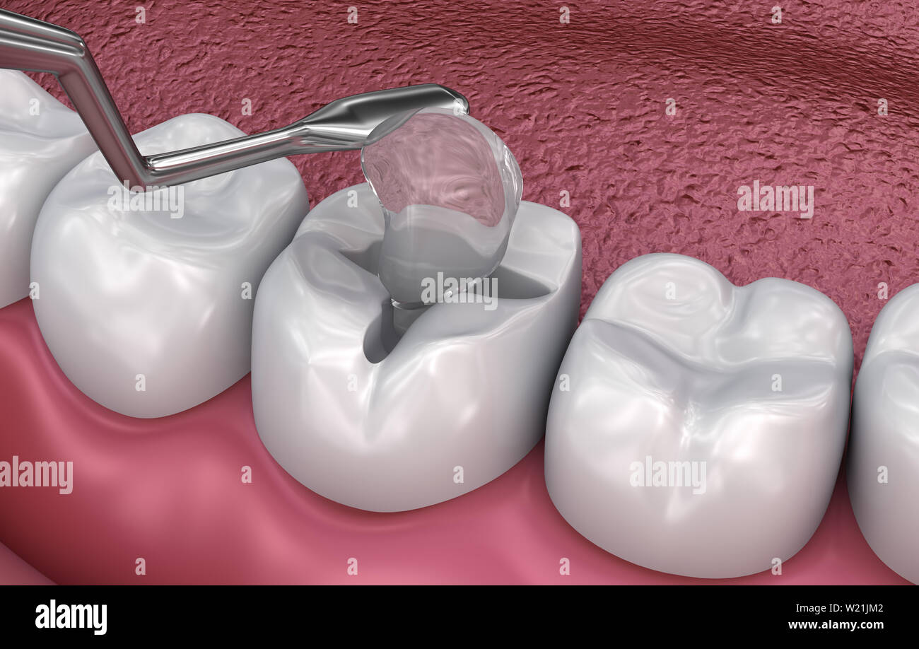 Dental fissure fillings, Medically accurate 3D illustration Stock Photo ...