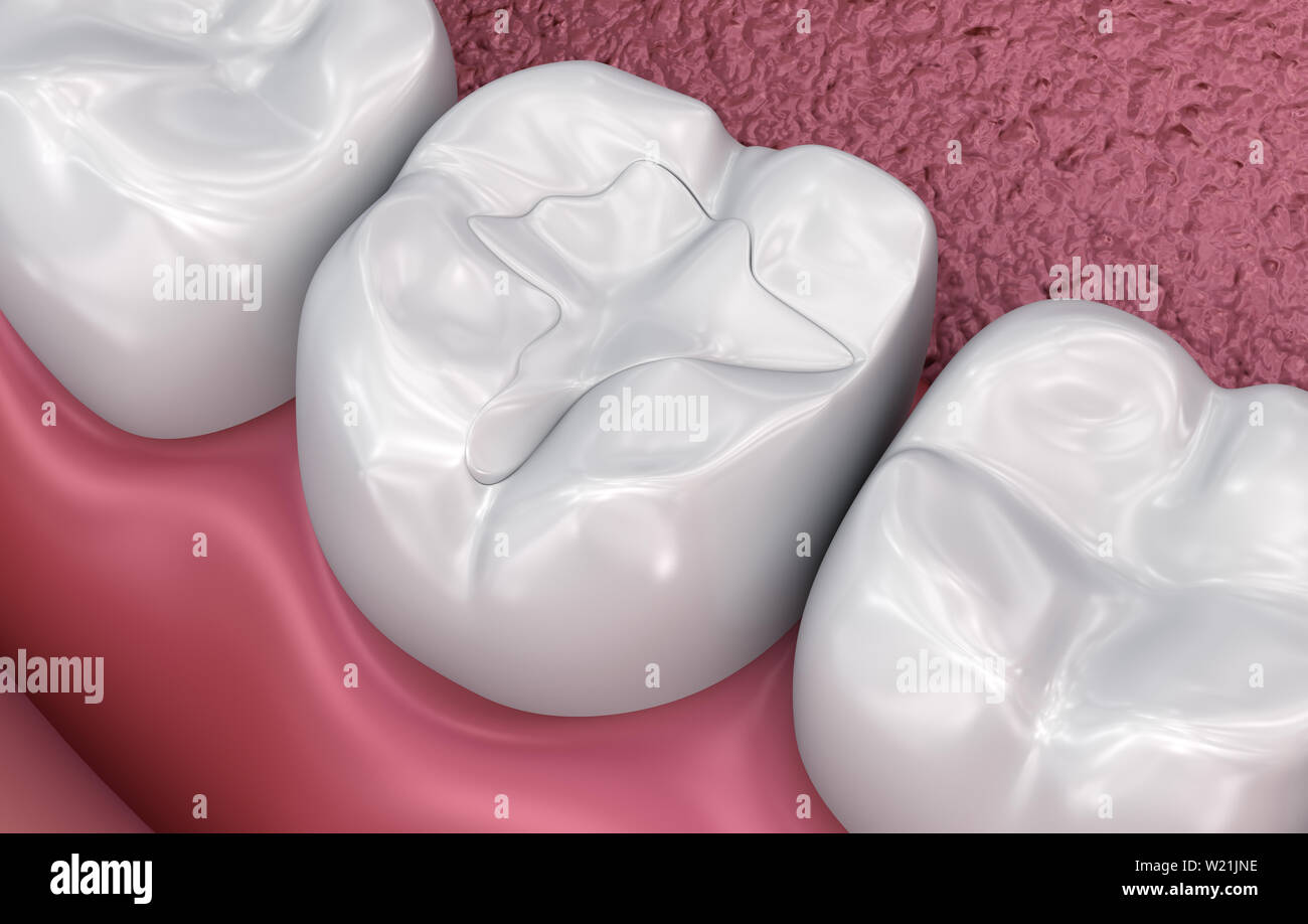 Dental fissure fillings, Medically accurate 3D illustration Stock Photo ...