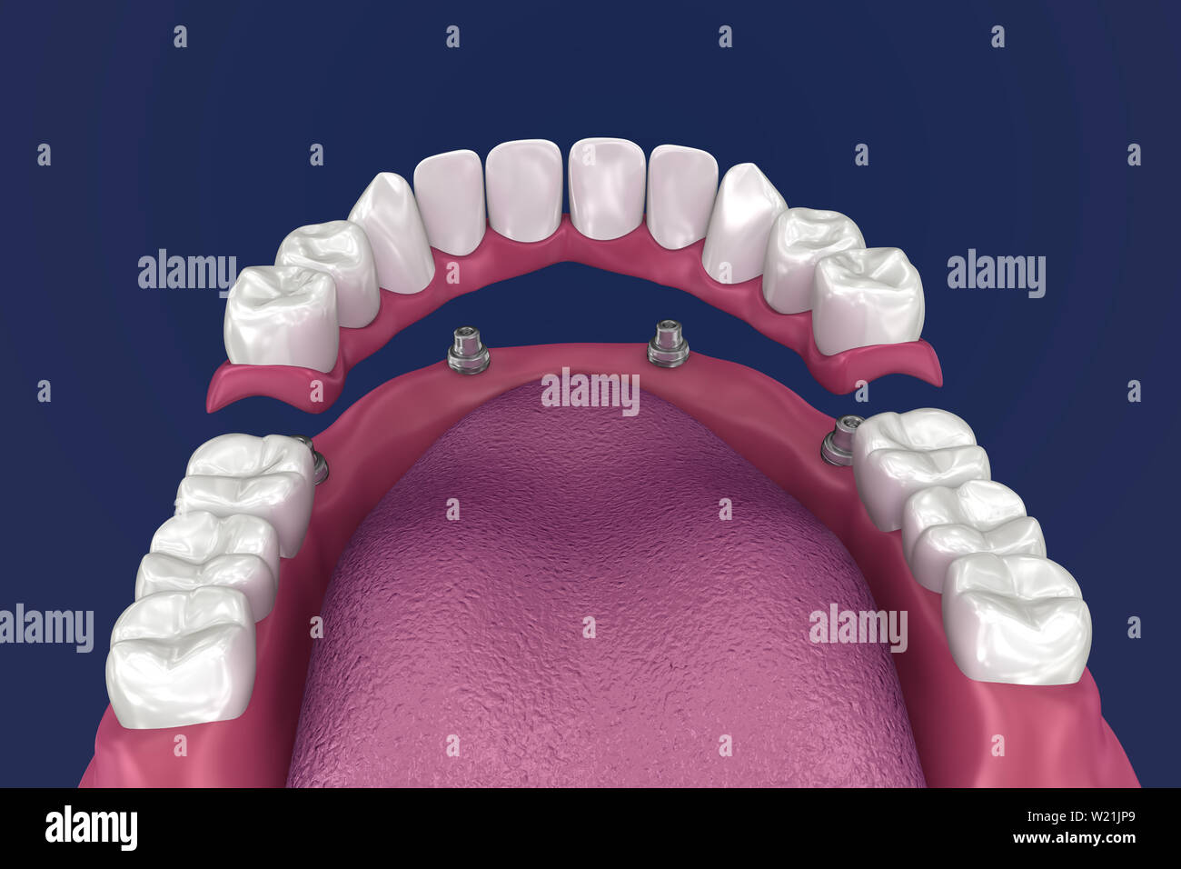 Overdenture to be seated on 4 implants - ball attachments. 3D ...
