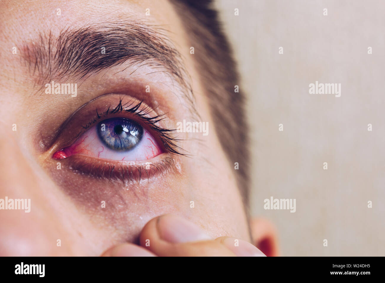 a man drips open human eye with bright red arteries drops to improve ...