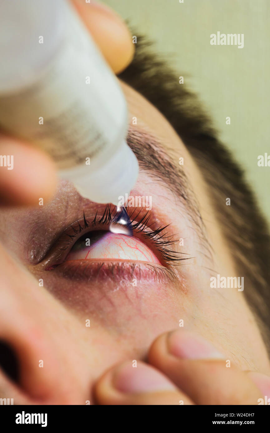 a man drips open human eye with bright red arteries drops to improve ...
