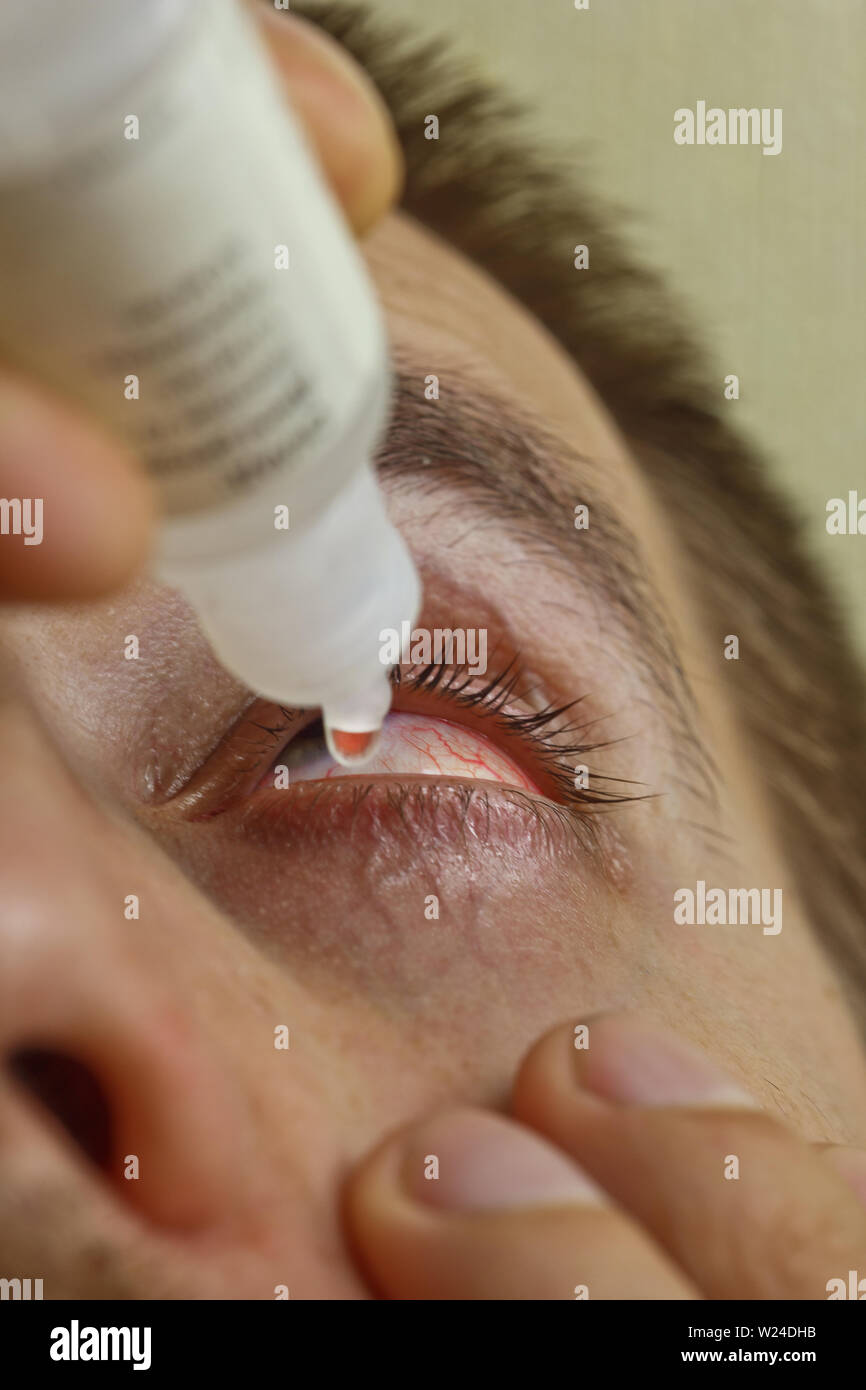 Man red eyes irritation hi-res stock photography and images - Alamy