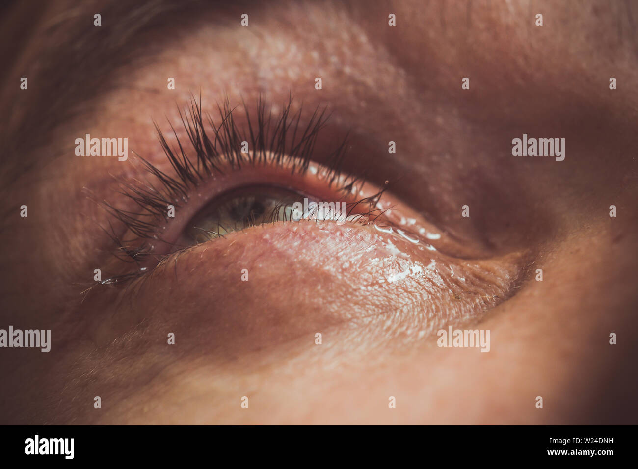 Conjunctivitis crying hi-res stock photography and images - Alamy